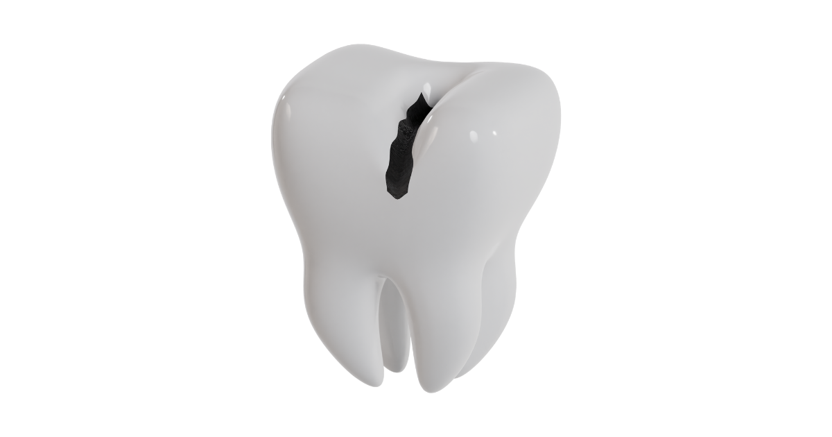 Se me ha roto una muela ¿qué debo hacer? - blog del dentista Premoden